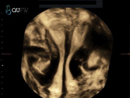 Gynaecology Ultrasound