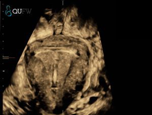 Gynaecology Ultrasound