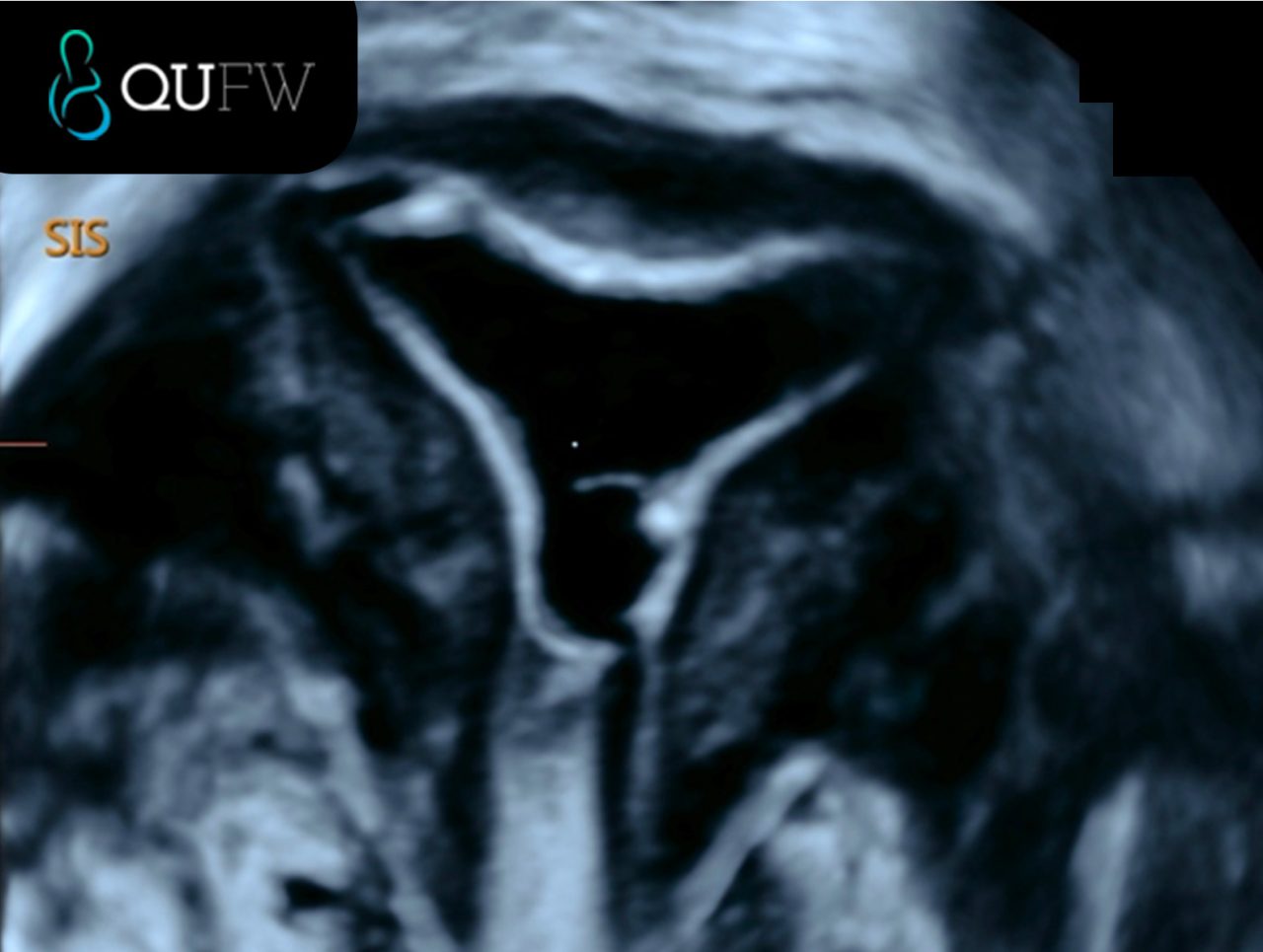 Saline Infusion Sonography