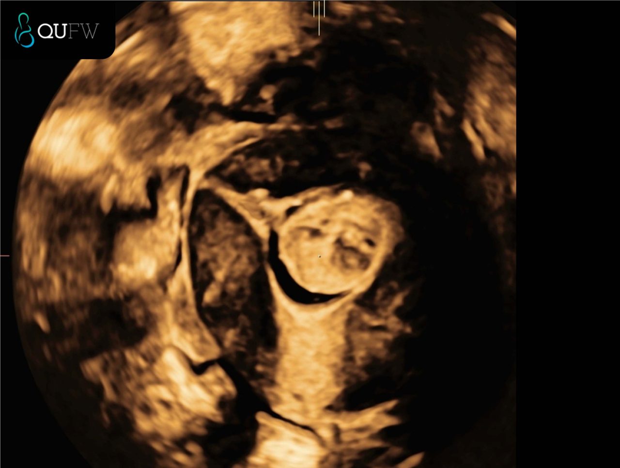 Saline Infusion Sonography