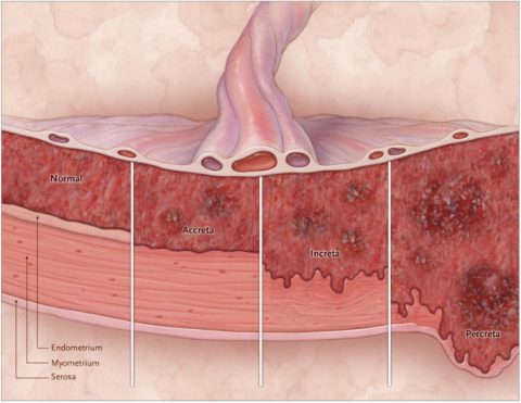 What is placenta accreta spectrum (PAS)? Let’s look at symptoms ...